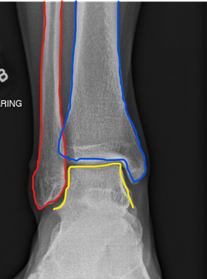 Treatment of Foot and Ankle Fractures | Dr. Marissa Jamieson | Denver, CO