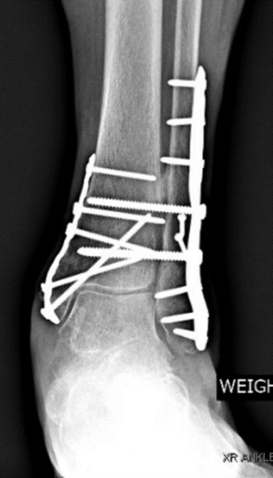 Treatment of Foot and Ankle Fractures | Dr. Marissa Jamieson | Denver, CO