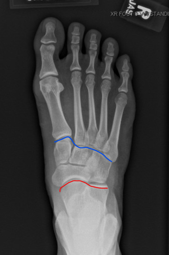 Treatment of Foot and Ankle Fractures | Dr. Marissa Jamieson | Denver, CO