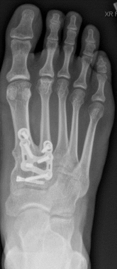 Treatment of Foot and Ankle Fractures | Dr. Marissa Jamieson | Denver, CO