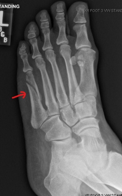 Treatment of Foot and Ankle Fractures | Dr. Marissa Jamieson | Denver, CO