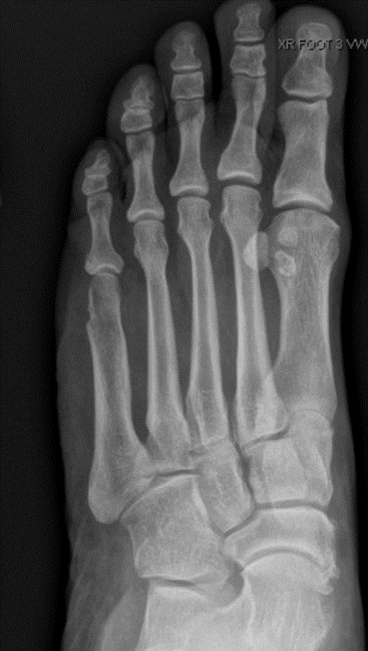Treatment of Foot and Ankle Fractures | Dr. Marissa Jamieson | Denver, CO