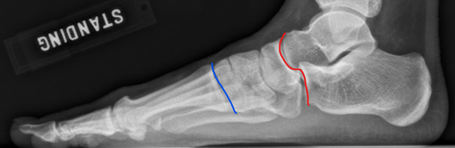 Treatment of Foot and Ankle Fractures | Dr. Marissa Jamieson | Denver, CO