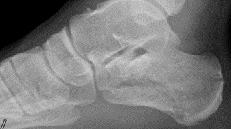 Treatment of Foot and Ankle Fractures | Dr. Marissa Jamieson | Denver, CO