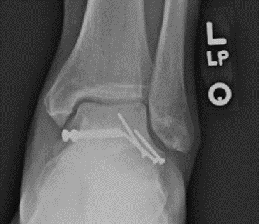 Treatment of Foot and Ankle Fractures | Dr. Marissa Jamieson | Denver, CO
