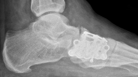 Treatment of Foot and Ankle Fractures | Dr. Marissa Jamieson | Denver, CO