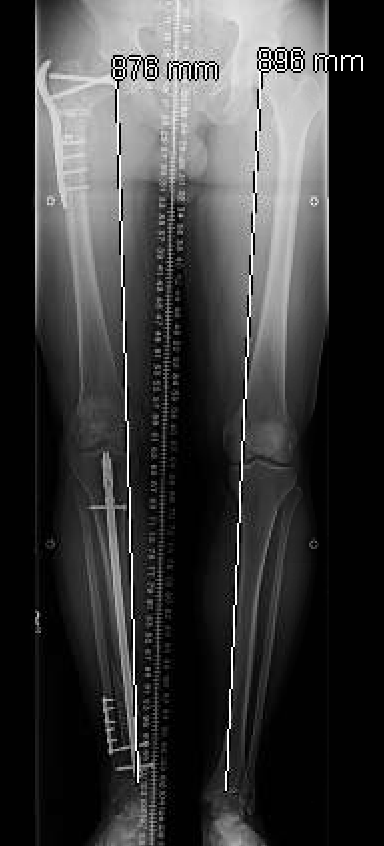 Limb Restoration | Dr. Jason Stoneback | University of Colorado