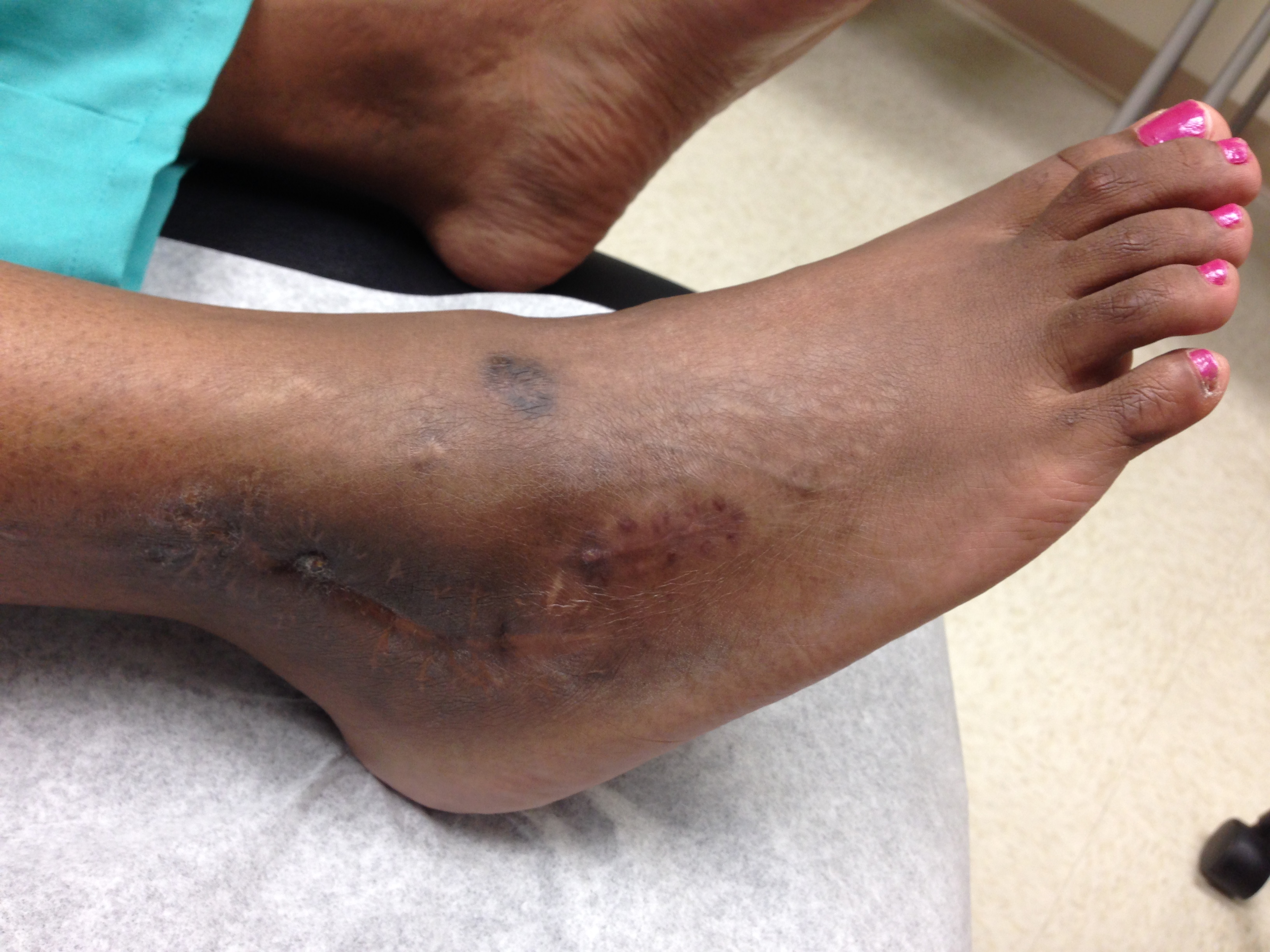 Soft Tissue Sarcoma| CU School of Medicine, University of Colorado